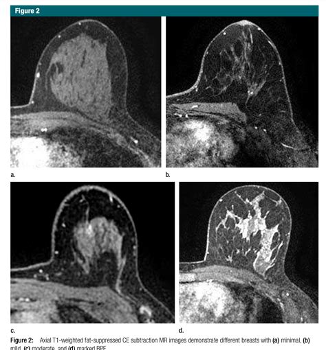 Figure 1 From Comparison Of Background Parenchymal Enhancement At