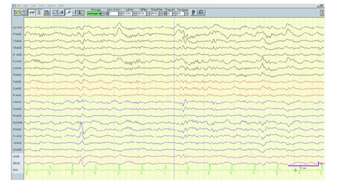 Post Ictal Eeg Showed Focal Paroxysmal Epileptiform Sharp And Slow