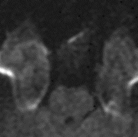 Differentiation Of Benign And Malignant Head And Neck Lesions With