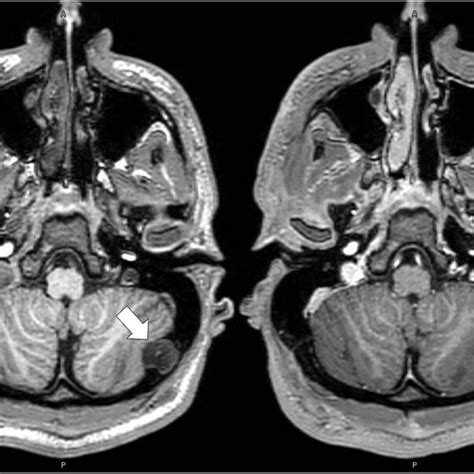 Axial T1 Weighted Mri Of Retroauricular Epidermoid Cyst Before Left