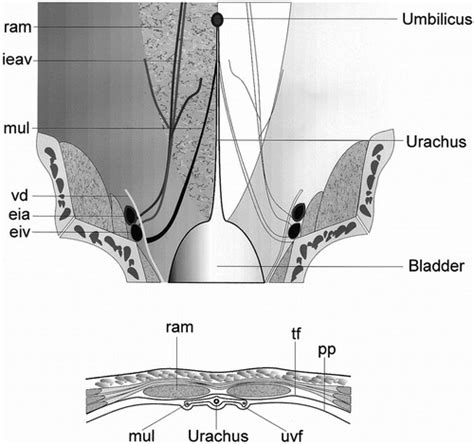 Urachal Remnant Diseases Spectrum Of Ct And Us Findings Radiographics