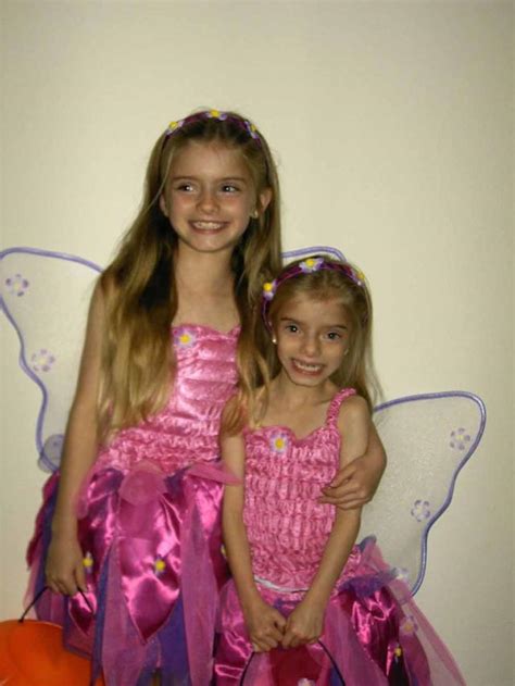 Worlds Only Identical Twin With Primordial Dwarfism Lifts The Lid On