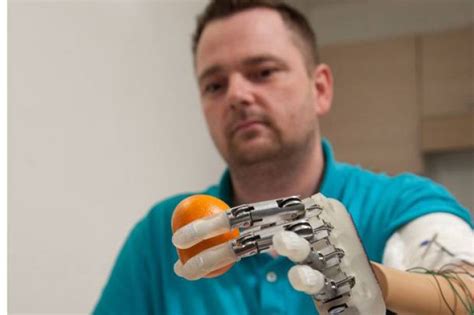 Bionic Hand Restores Amputees Sense Of Touch In Prosthetic After