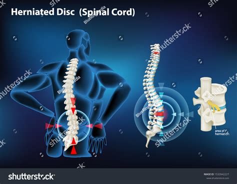 Diagram Showing Herniated Disc In Human Royalty Free Stock Vector
