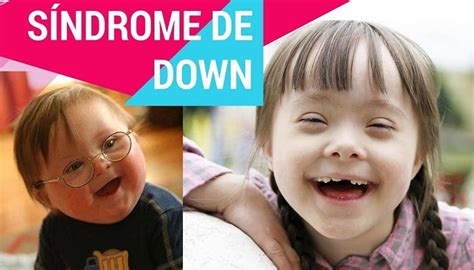 Síndrome De Down Causas Tipos Diagnostico Tratamiento Y Apoyo
