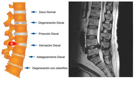 Tratamiento Hernia Discal Tratamiento Medico No Quirúrgico De La
