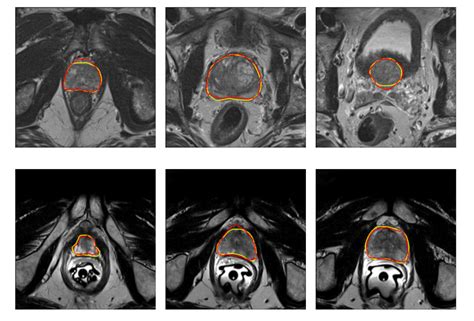 Fast Reliable Approximate Automatic Image Segmentation For Prostate Mri