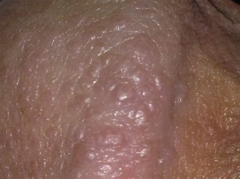 small bumps under tongue std