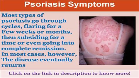 See Now Psoriasis Symptoms And Signs Youtube