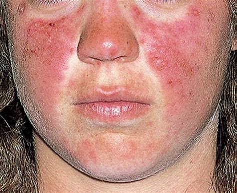 Early Lupus Symptoms What You Need To Look For