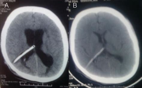 Endoscopic Third Ventriculostomy Indications And Challenges Intechopen