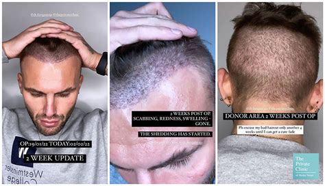 Hair Growth After Hair Transplant After Follicular Transfer Fue Hair
