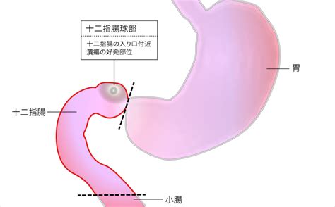 十二指腸潰瘍 じゅうにしちょうかいよう とは 済生会