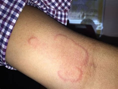 Xem Qua Hình ảnh Bệnh Sán Chó ở Người Và Nhận Diện Kịp Thời