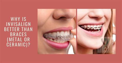 Why Is Invisalign Better Than Metal Braces Or Ceramic Braces