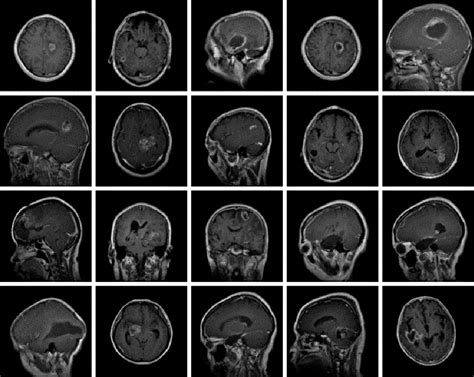 Figure 1 From Refined Automatic Brain Tumor Classification Using Hybrid