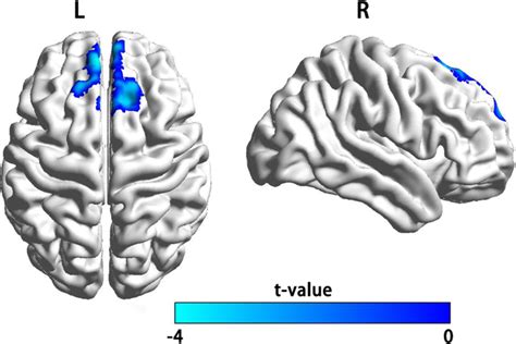 After Controlling For Age And Sex Participants With High Neuroticism