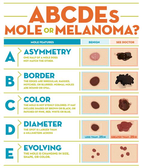 Abcde Rule Of Skin Cancer Detection