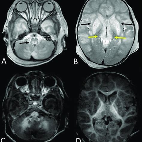 Axial T2 Weighted A And B And T1 Weighted C And D Mr Images Show