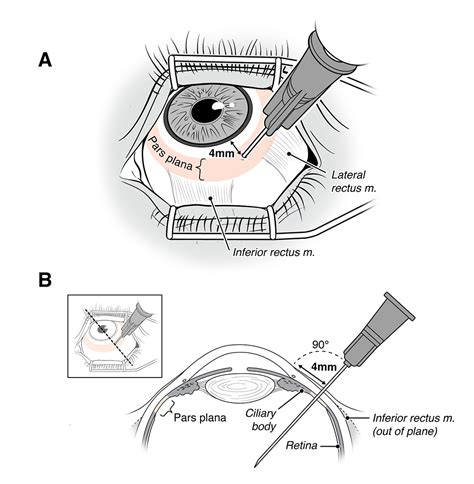 Intravitreal Injection Jackie Kustan Medical Illustration