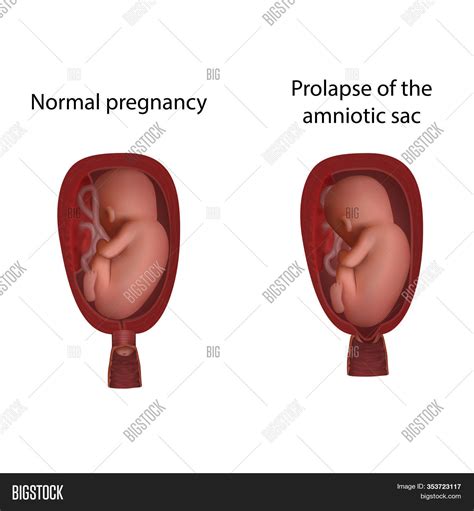 Prolapsed Cervix Photos – Telegraph