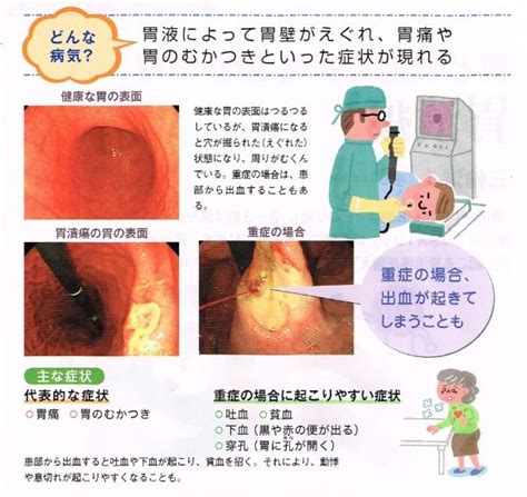 胃潰瘍の症状・原因・治療【胃痛や胃がむかつく】