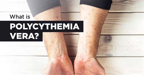 What Does Polycythemia Vera Mean