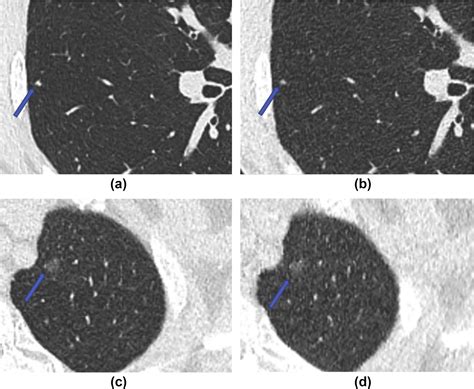 Ultra Low Dose Ct Reconstructed With Asir V Using Smartma For Pulmonary