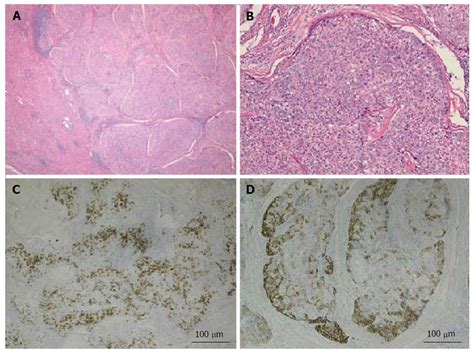Clinical Features Histology And Histogenesis Of Combined