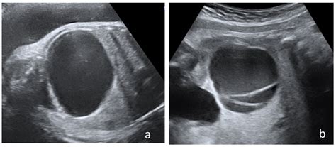 Fetal Ovarian Cysts Prenatal Diagnosis Using Ultrasound And Mri