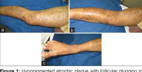Figure 1 From Extragenital Lichen Sclerosus Et Atrophicus Along The