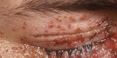 eyelid eczema here s exactly how to treat it self