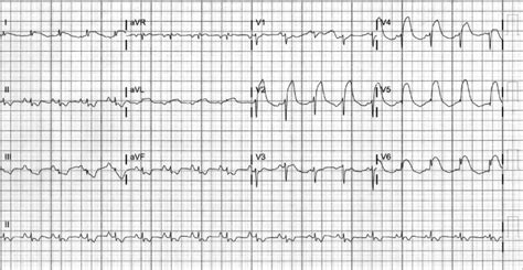 The 12 Lead Electrocardiogram Showing Extensive Septal Anterior Lateral