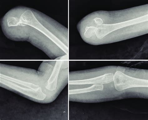 Two Year Follow Up Radiographs Of Both Elbows For Comparison Showing