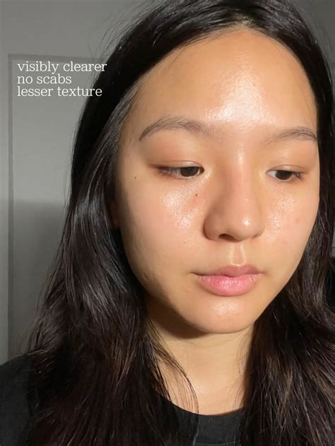 My Skin Got Better So Did My Confidence แกลเลอรีที่โพสต์โดย Amanda