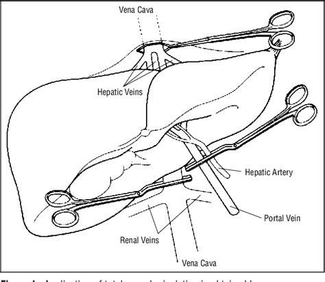 Figure 1 From Is Any Method Of Vascular Control Superior In Hepatic