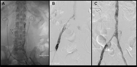 Savs Ultrasonic Accelerated Thrombolysis Of Ivc Thrombosis