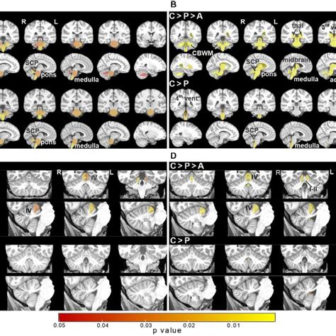 Whole Brain And Cerebellar Volumetry Statistical Maps Of Whole Brain