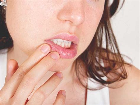 angular cheilitis symptoms causes and treatments