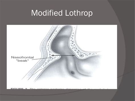 Ppt Frontal Sinus Surgery Powerpoint Presentation Free Download Id