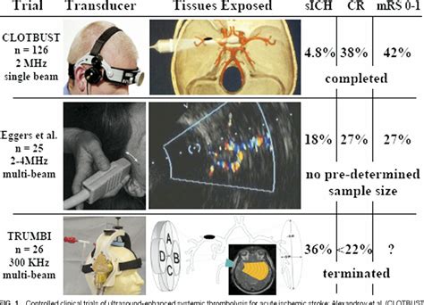 [pdf] Ultrasound Enhanced Thrombolysis In Acute Ischemic Stroke