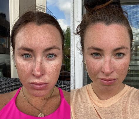 You Wont Believe These Complete Collagen Before And After Photos