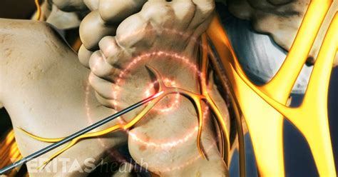 Radiofrequency Ablation Procedure