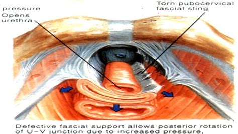 Vault Prolapse Pelvic Organ Prolapse Supports Of Uterus
