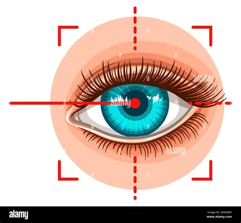 Cirugía Ocular Láser Procedimiento Médico De Corrección De La Visión