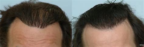 Hair Transplant Before And After Forhair Hair Transplant Results