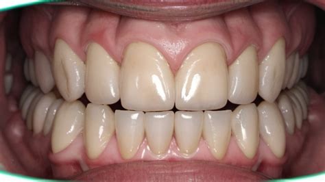 Comprehensive Guide Finding The Right Orange County Implant Dentist