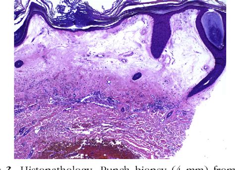 Figure 3 From Palmar Lichen Sclerosus Et Atrophicus Semantic Scholar