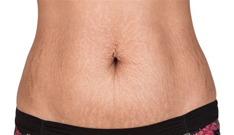 4 Ways To Remove Stretch Marks And 1 Way To Hide Them For Good