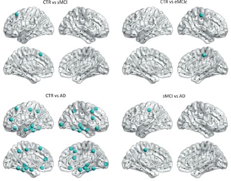 Significant Decreases In The Nodal Clustering Coefficient In Smci